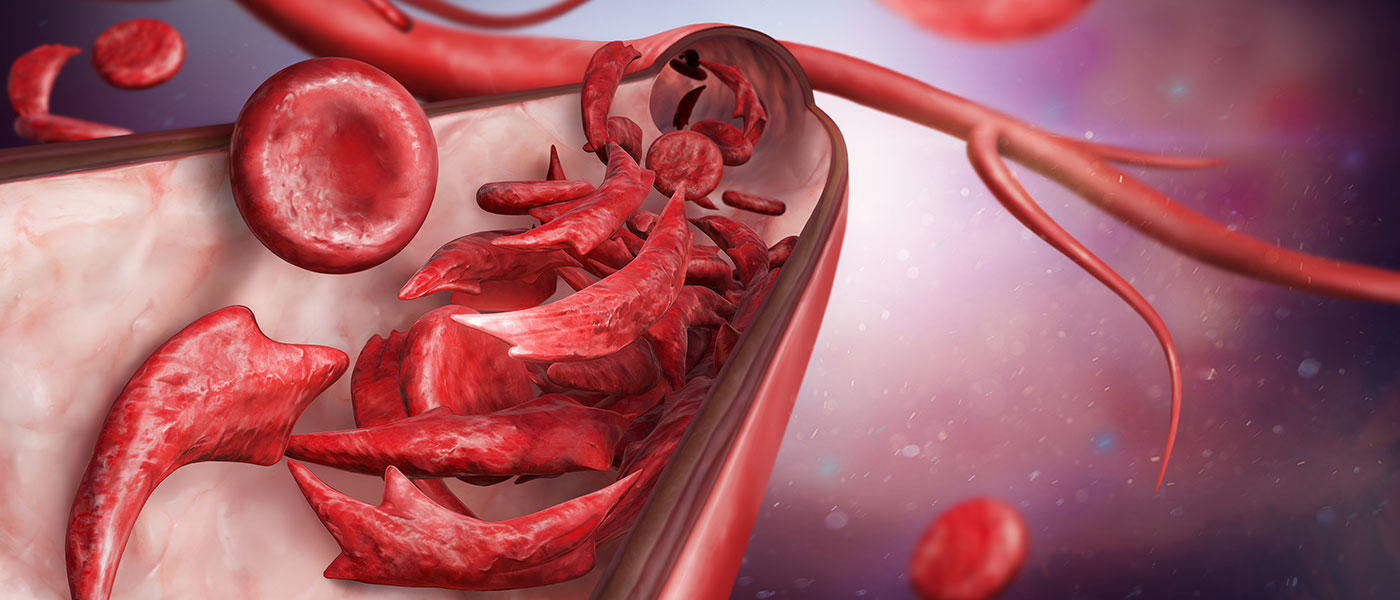 Fighting sickle cell disease in America | Case School of Engineering ...